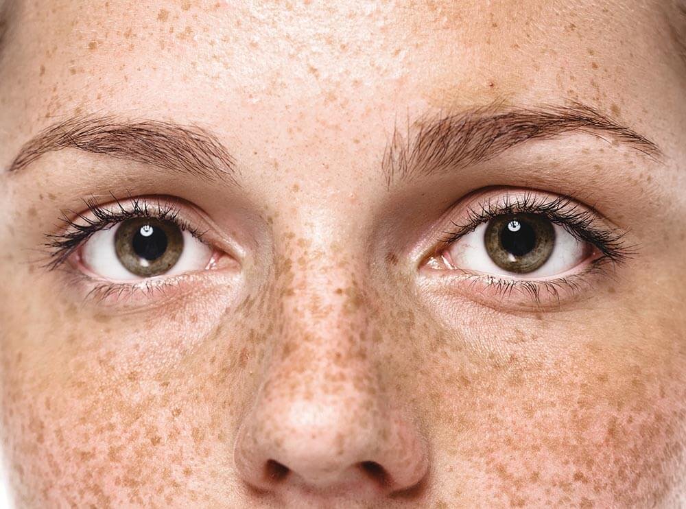 Get Rid of Hyper-pigmentation with Hydroquinone 4