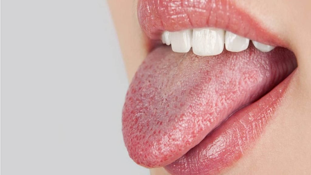 The Causes of Dry Mouth and How to Combat Them