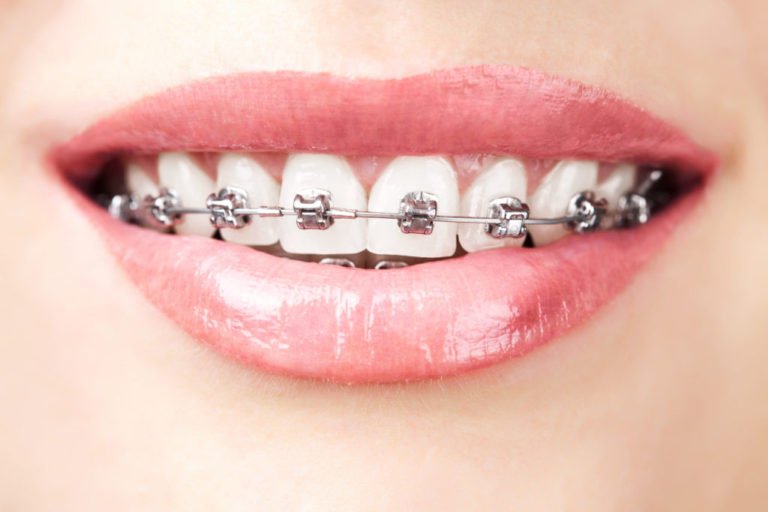 The Full Guide of Having Braces
