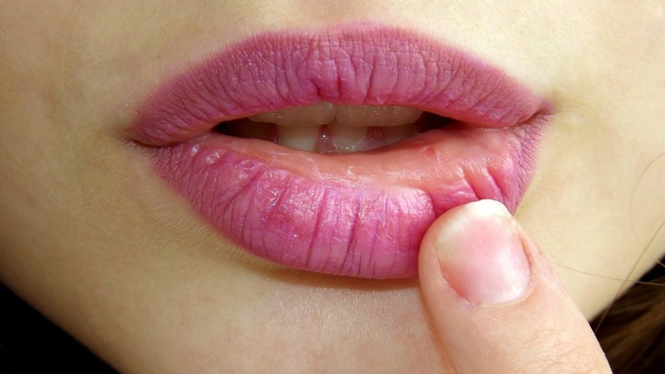 7 Must Know Cold Sore Facts 7-must-know-cold-sore-facts